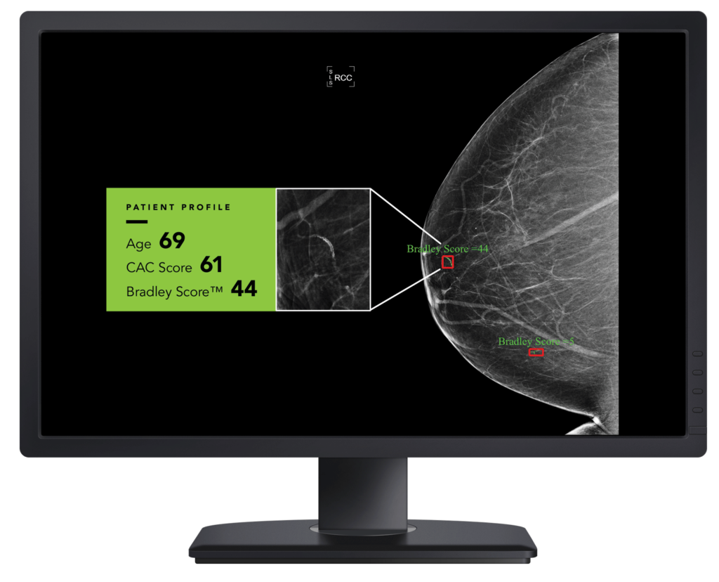 cmAngio® Mammogram Software - CureMetrix Catch Cancers Early