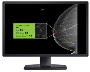 cmAngio® Mammogram Software - CureMetrix Catch Cancers Early